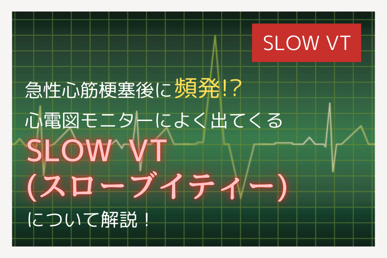 急性心筋梗塞後に頻発？心電図モニターによく出てくるSLOW VT（スローブイティー）について解説！ | 障がいマナビサイト